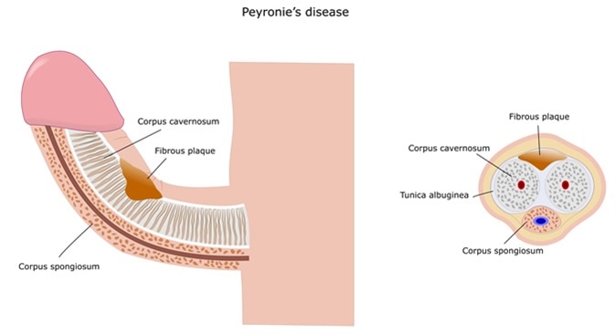 Peyronies Disease Dr Anish Kumar Gupta