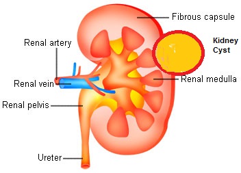 Simple Renal Cysts - Dr Anish Kumar Gupta